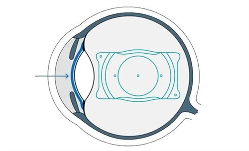 icl晶体v4c和v5的区别有哪些？从适应人群/光学区大小/瞳孔覆盖范围介绍分享！ - 三恩健康网