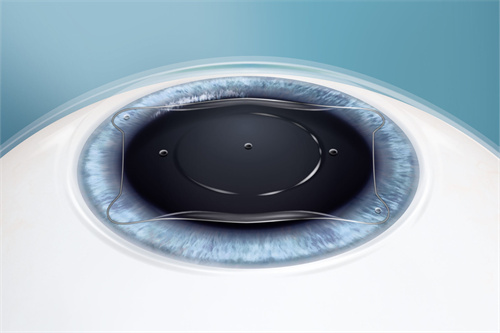 深度解析ICL晶体V5与V4差异：从性能到结果，第五代ICL晶体对比第四代全方面升级！ - 三恩健康网